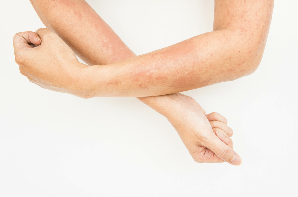 Understanding Different Types of Dermatitis: Causes, Symptoms, and ...